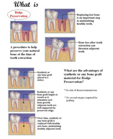 Bone Graft and Extraction Site Preservation - El Camino Dental